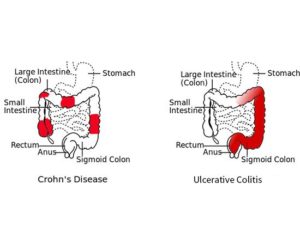 Inflammatory Bowel Disease – Ooigastro